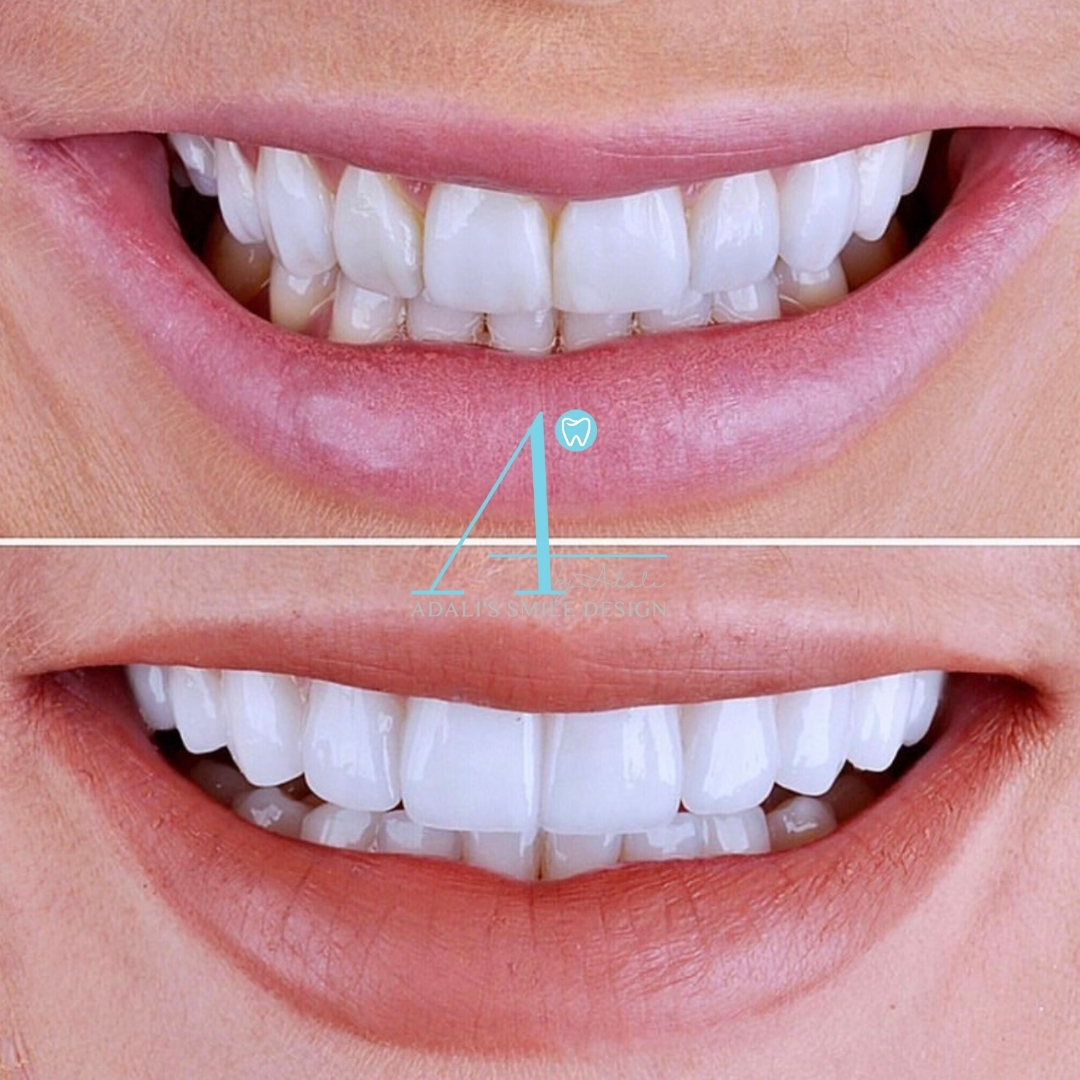 Lächeln-Galerie - Adali’s Smile Design